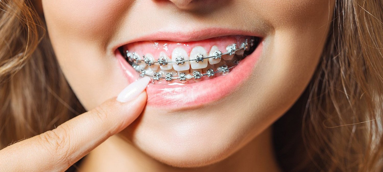 Metal and Ceramic Braces - Alesayi Specialized Dental Center